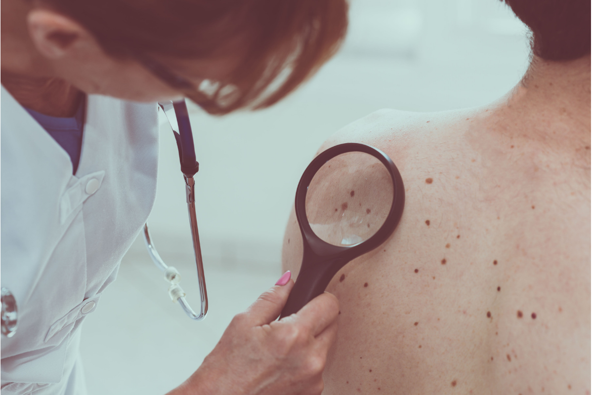 Signs Of Late Stage Skin Cancer